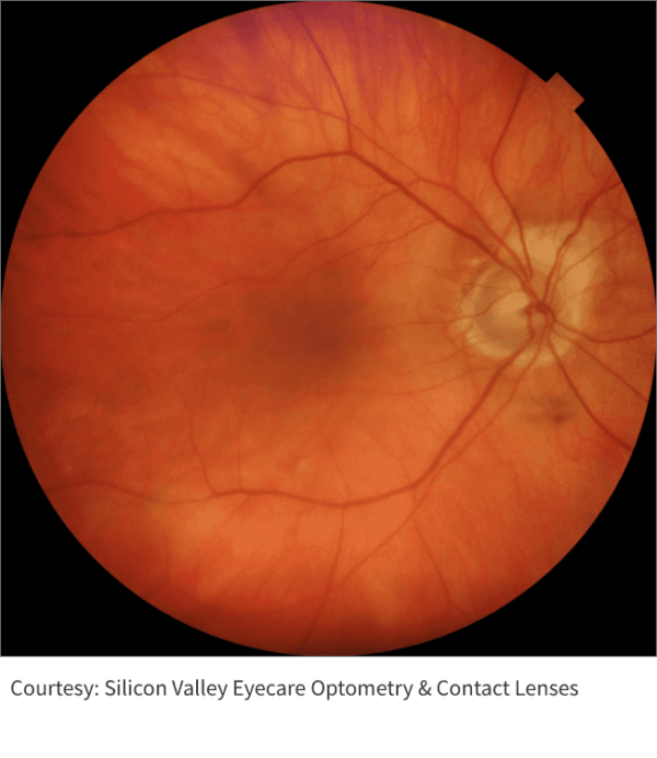 Topcon NW500 Non-mydriatic Retinal Camera | shapeophthalmics.com